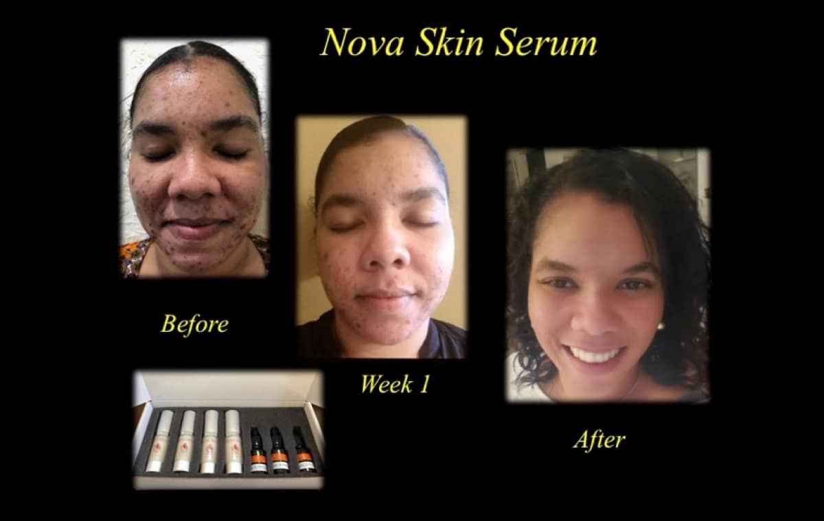 Novi Skin CRP: The Future of Skin Regeneration